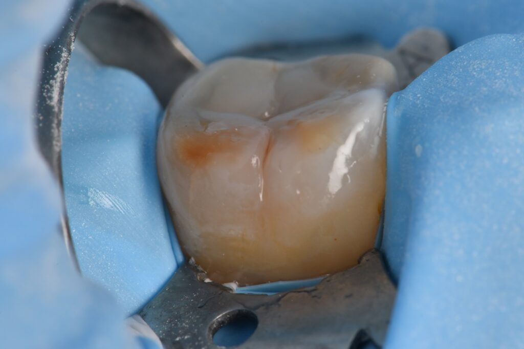 Considerations for Bonding to Molar Hypomineralization