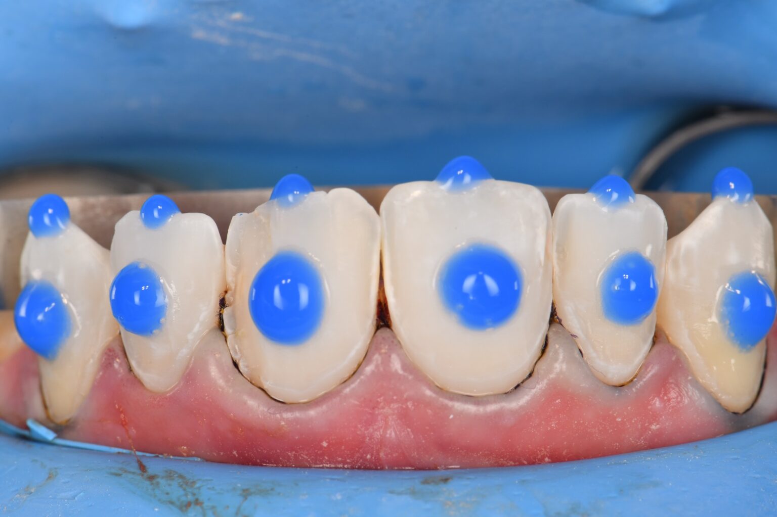 Composite Veneers to correct enamel dysplasia