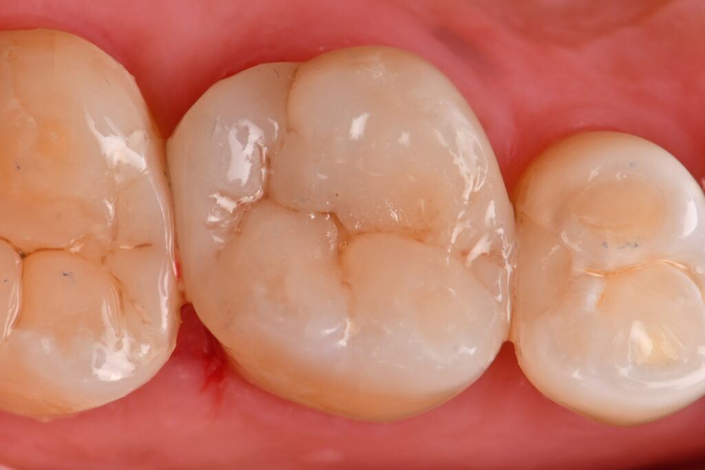 Supercomposite for large dose direct composite restorations
