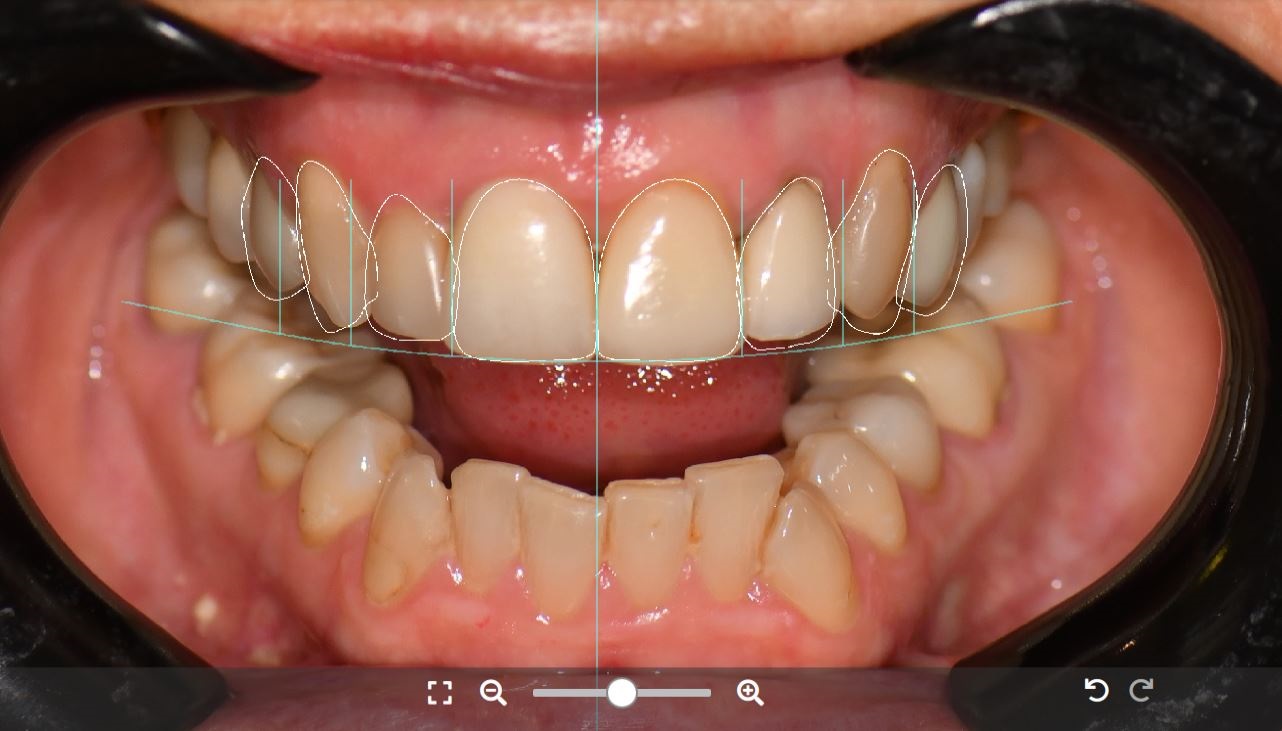 Ultradent Gemini used in balancing pink esthetics