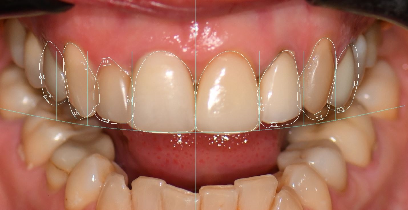 Ultradent Gemini used in balancing pink esthetics