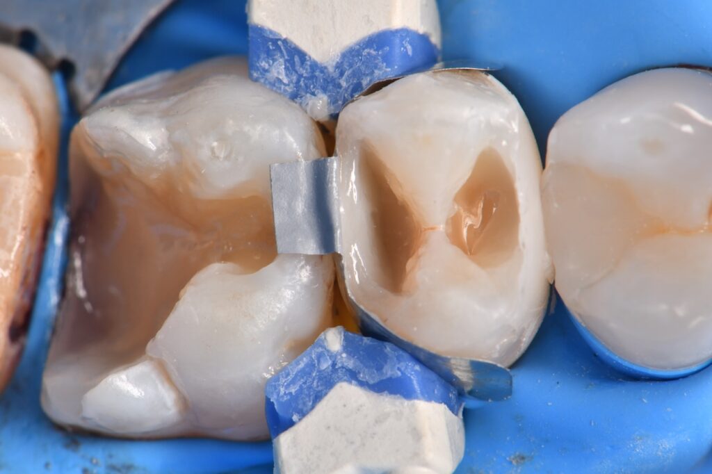 Complex reconstruction of a molar using direct composite