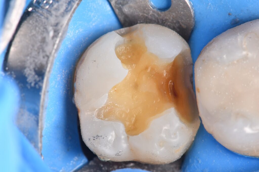 Amalgam and overhang removal