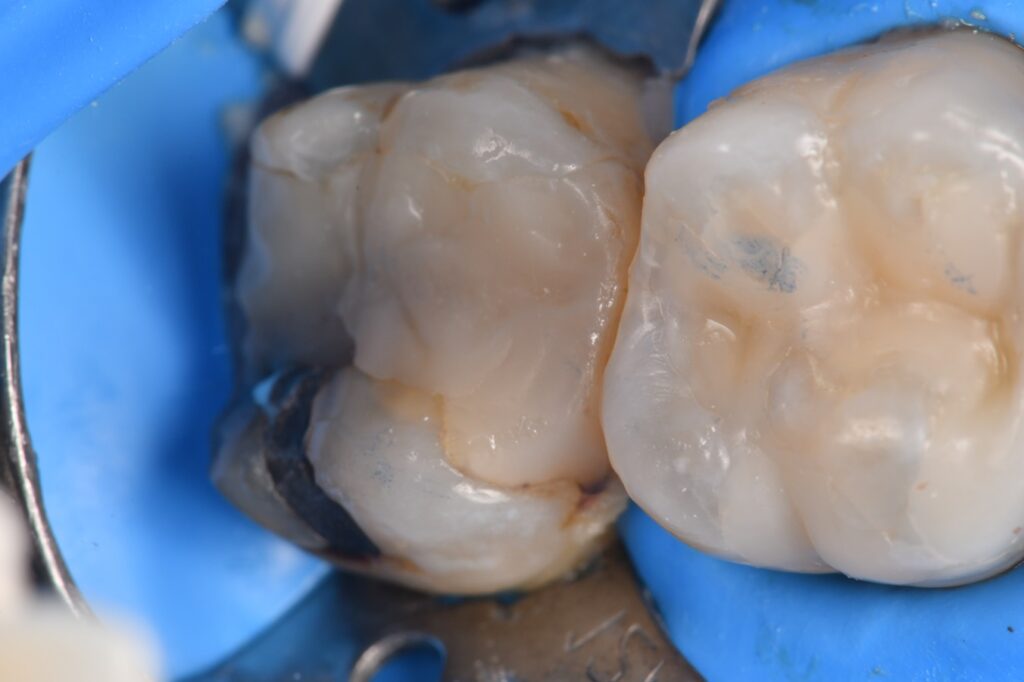 Adhesive Dental Overlay Design