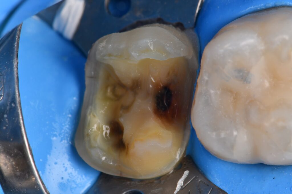 Adhesive Dental Overlay Design