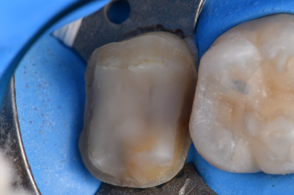 Adhesive Dental Overlay Design