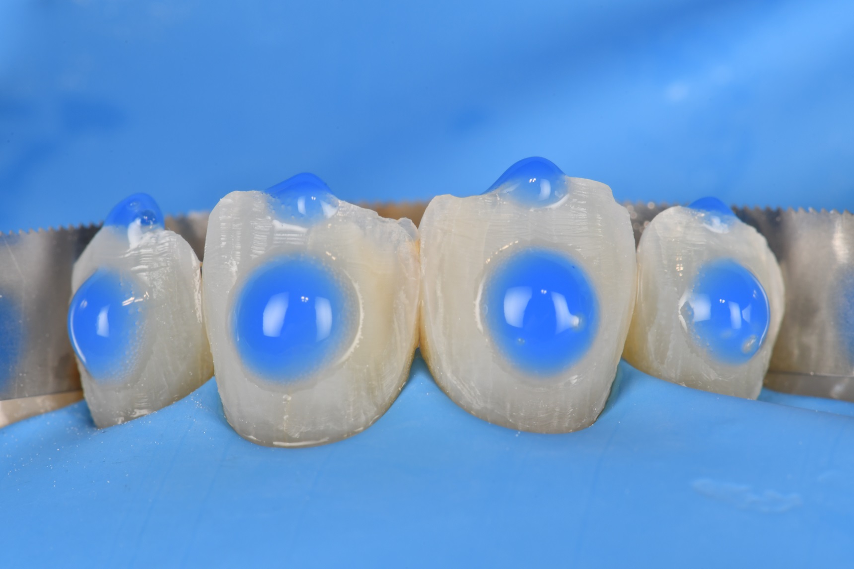 Voco Amaris used in Restorative Orthodontics