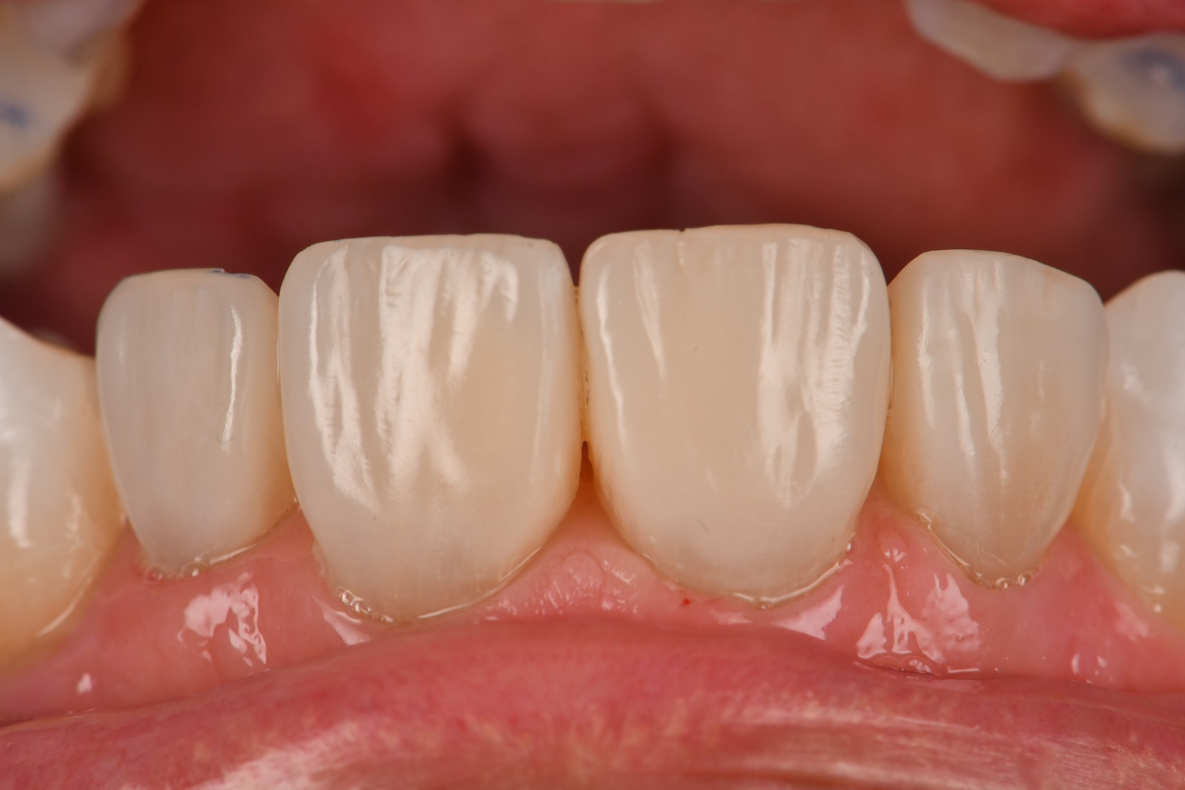 Voco Amaris used in Restorative Orthodontics