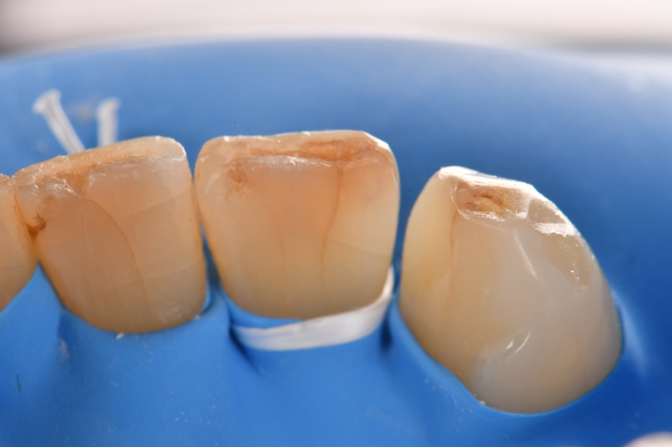 Enamel Crack Stabilization