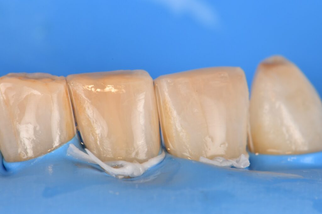 Enamel Crack Stabilization