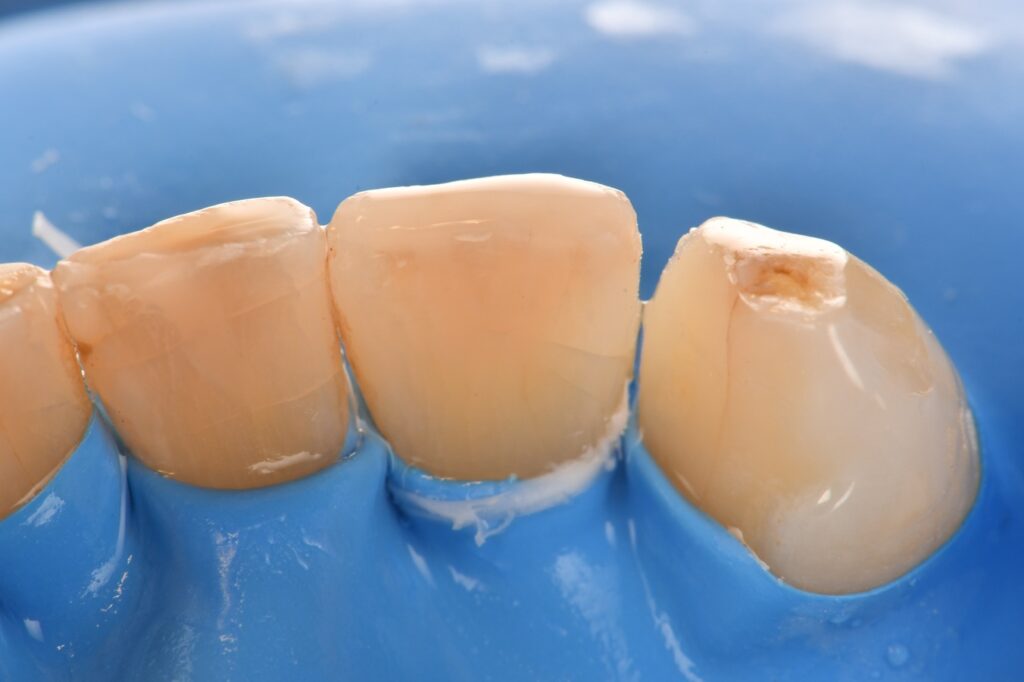Enamel Crack Stabilization