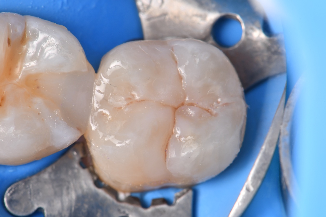 Bonding to Old Resin Protocol