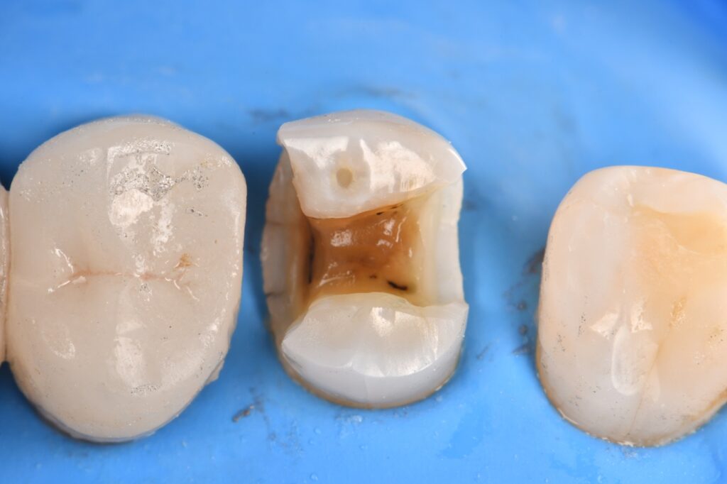 Matrix in Matrix to create free end axial contours