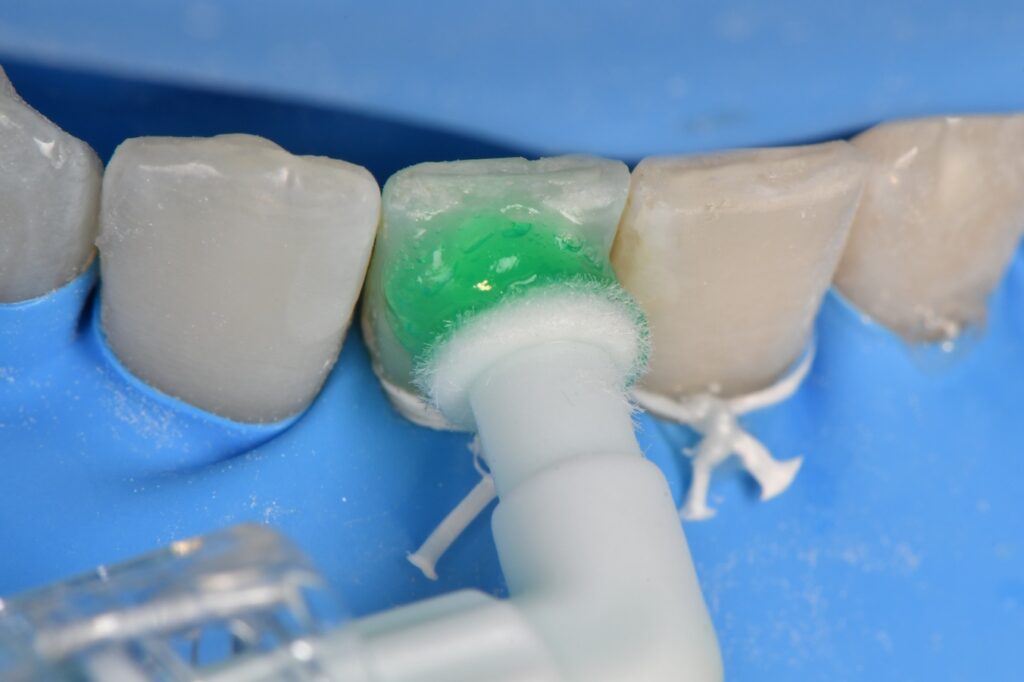 Resin Infiltration Tips