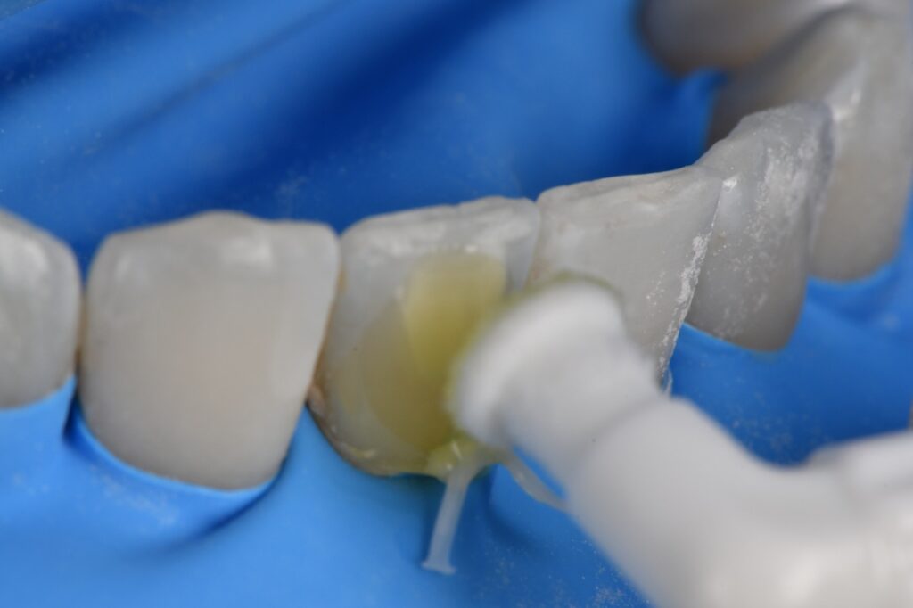 Resin Infiltration Tips