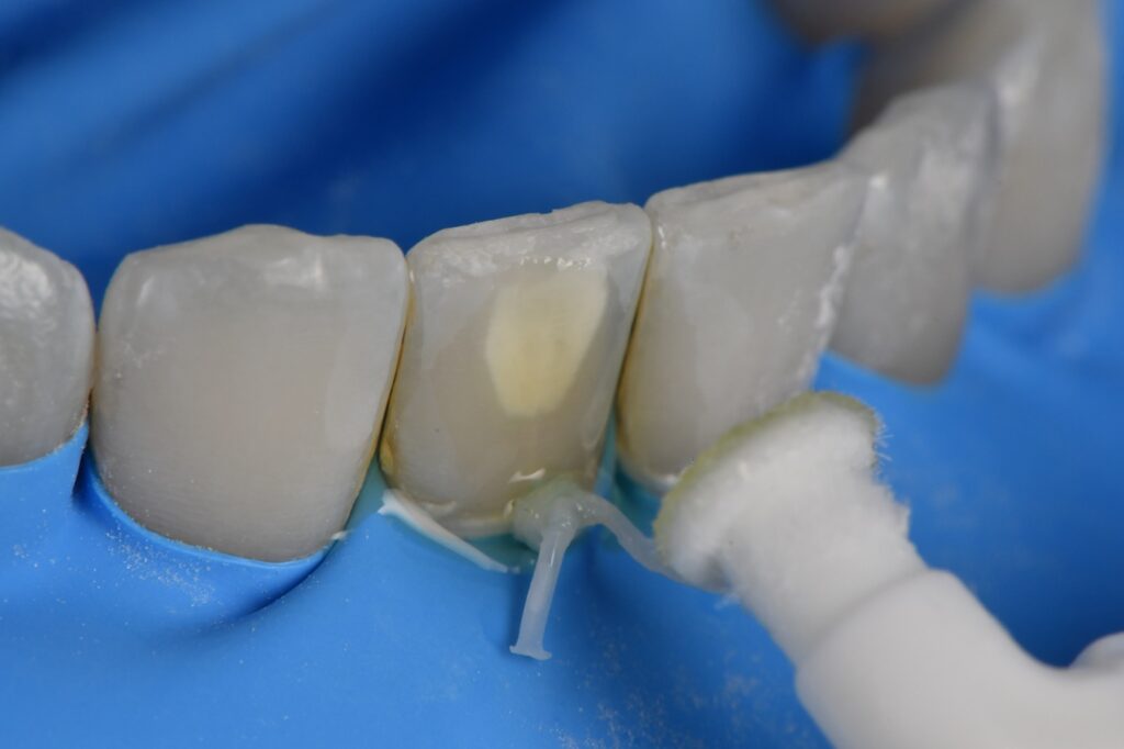 Resin Infiltration Tips