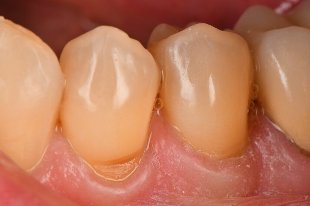 Class V abrasion lesions restored with A’Chord
