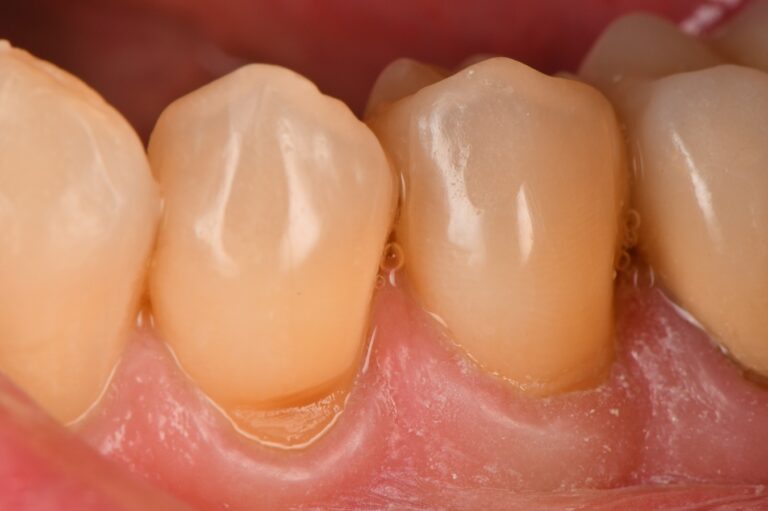 Class V abrasion lesions restored with A’Chord