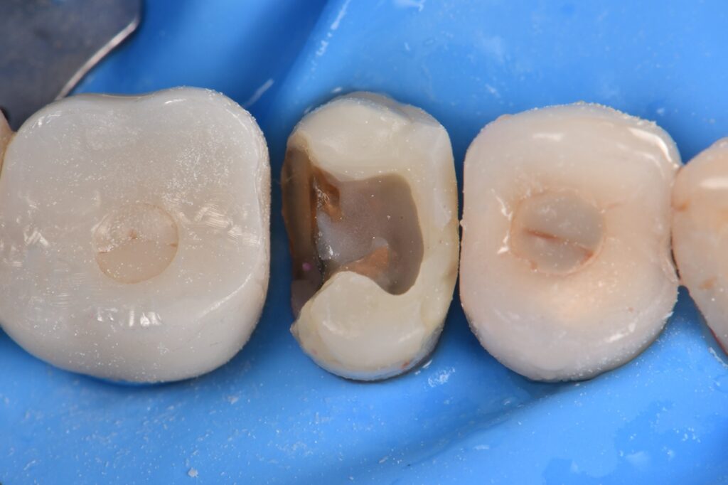 Partial reconstruction of a complex composite restoration
