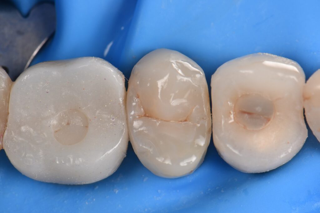 Partial reconstruction of a complex composite restoration