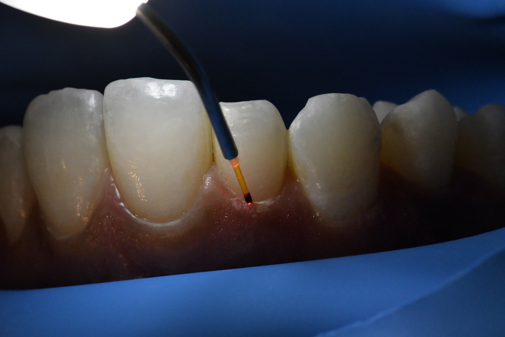 Composite Veneers and Tissue Recontouring with Gemini Evo