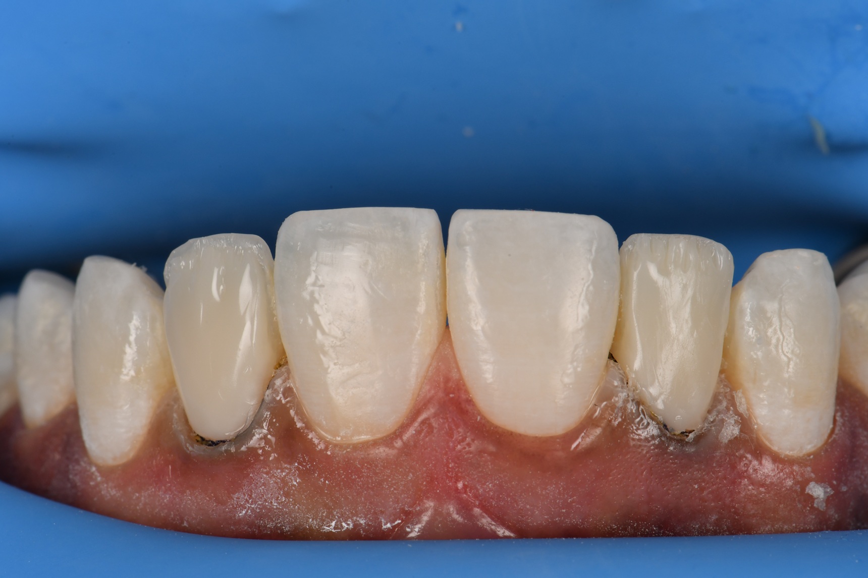 Composite Veneers and Tissue Recontouring with Gemini Evo