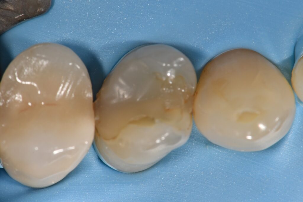 Line angle reconstruction in direct composite with Garrison Wide Prep Ring