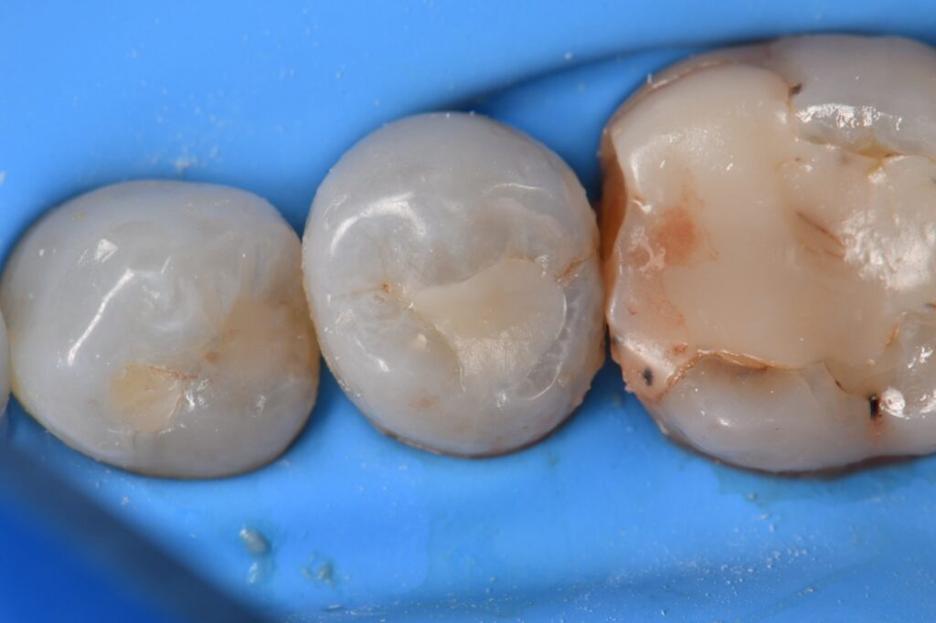 Vertical hairline fractures seed secondary caries