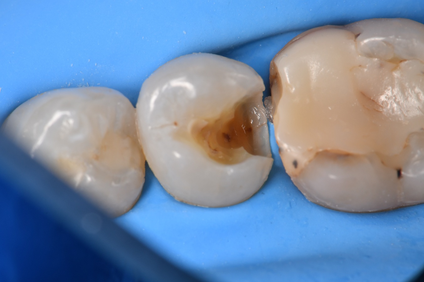 Vertical hairline fractures seed secondary caries
