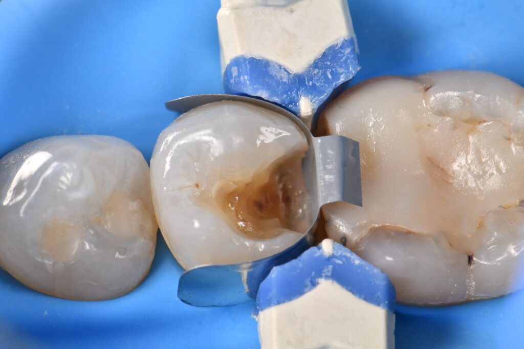 Vertical hairline fractures seed secondary caries