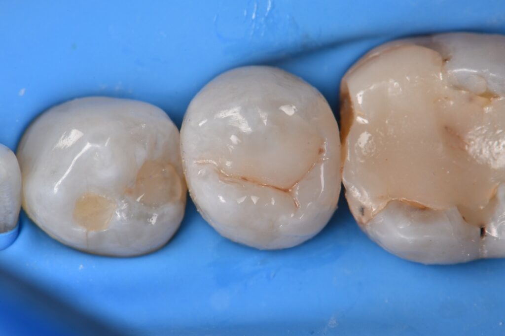 Vertical hairline fractures seed secondary caries