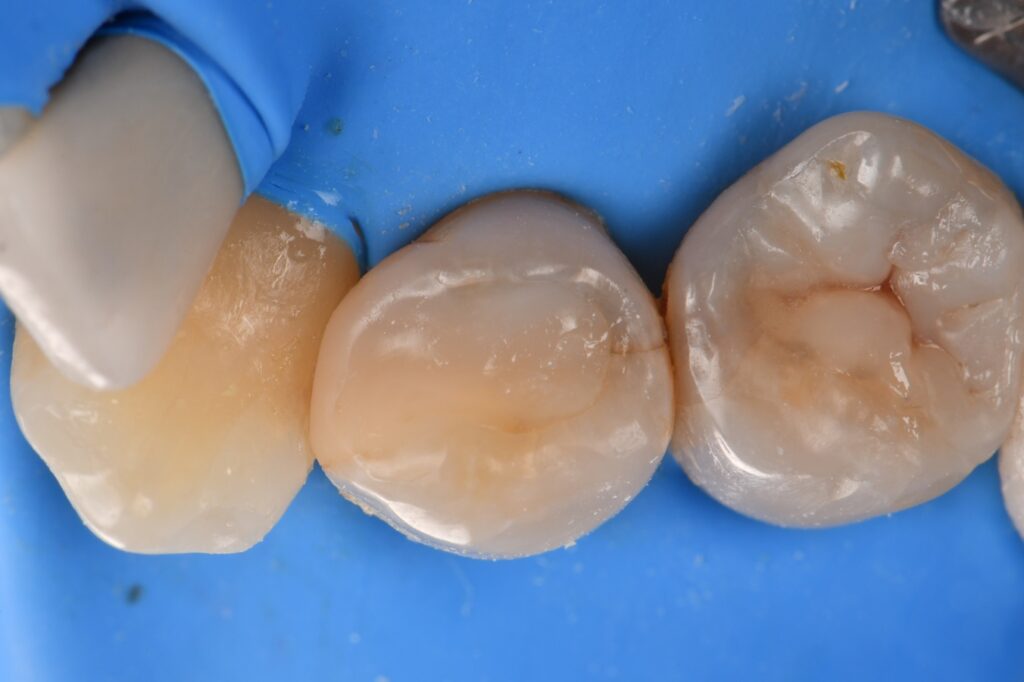 Overcontoured composite restoration correction