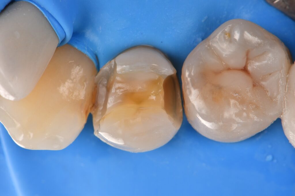 Overcontoured composite restoration correction