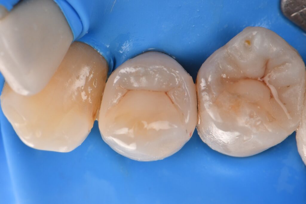 Overcontoured composite restoration correction