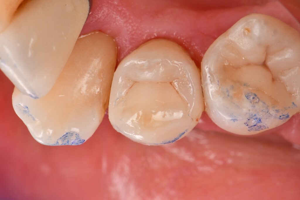 Overcontoured composite restoration correction