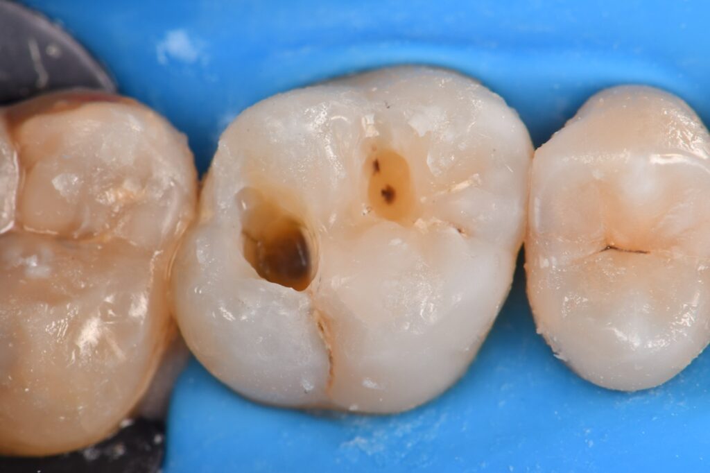 Occlusal composite artistry in a molar