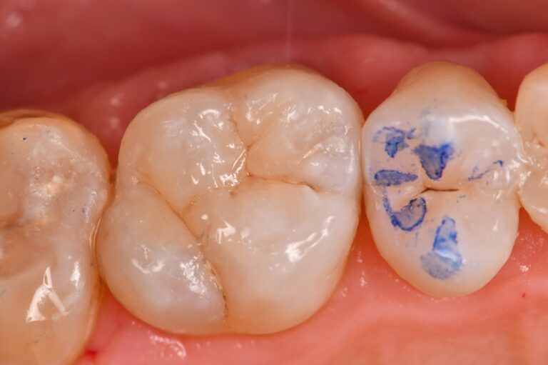 Occlusal composite artistry in a molar