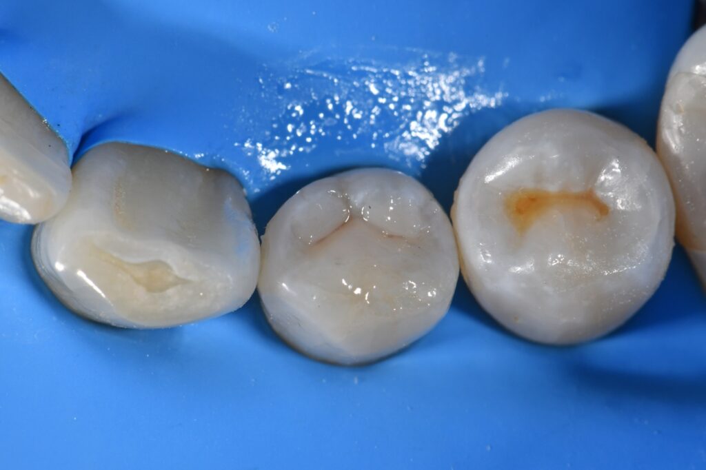 Subtleties in staining