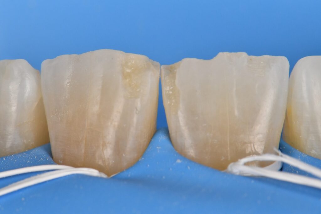 Black Triangle Reduction in Triangular Teeth