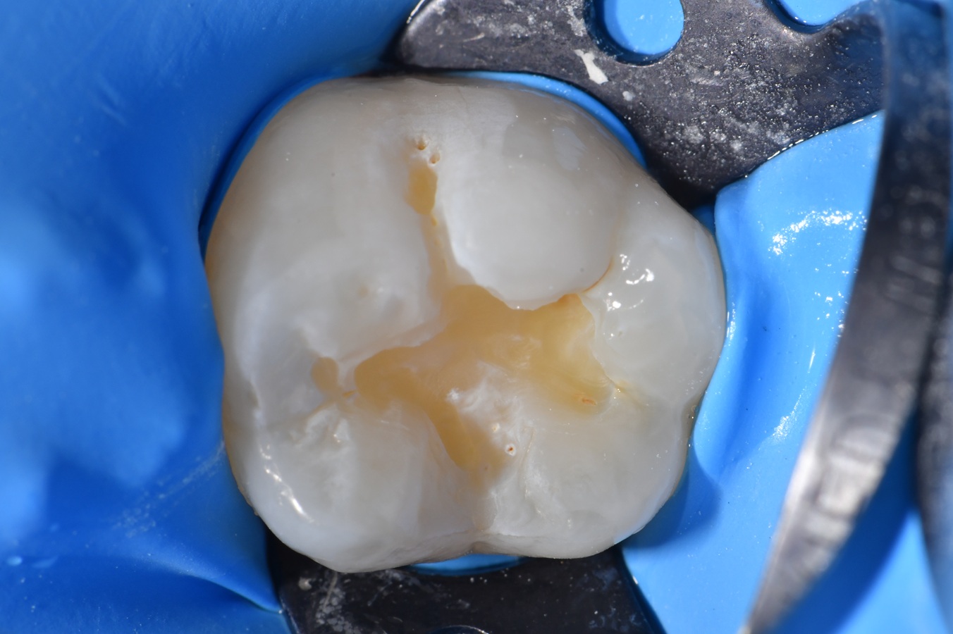 Class I composite replacement restorations