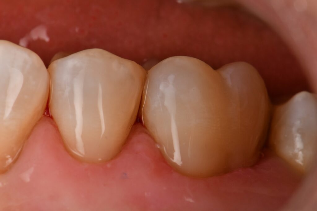 Class V lesions restored with GC Essentia U