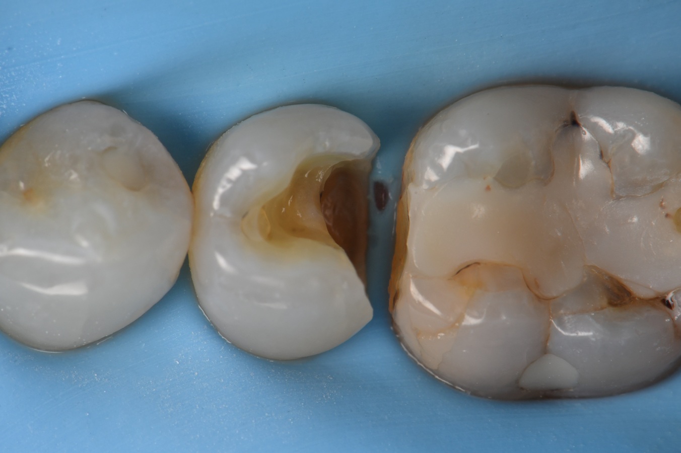Class II restoration invisibility with composite resin