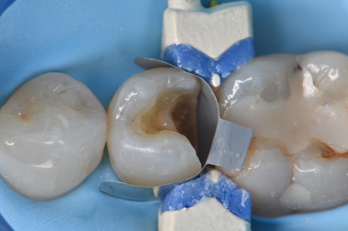Class II restoration invisibility with composite resin