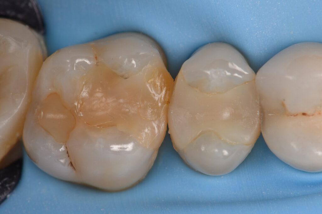 Matrix in Matrix used in a B2B Class II composite restoration