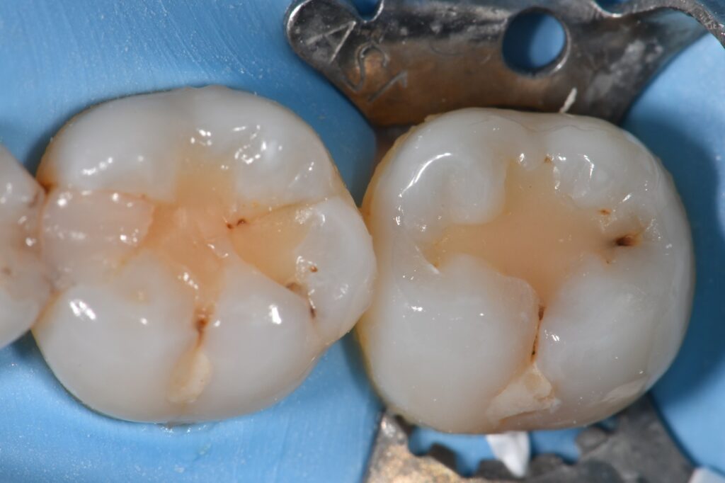 Band in band matrix technique for back to back Class II restorations
