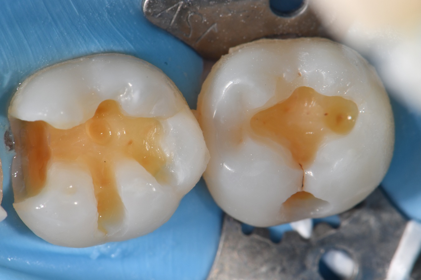 Band in band matrix technique for back to back Class II restorations