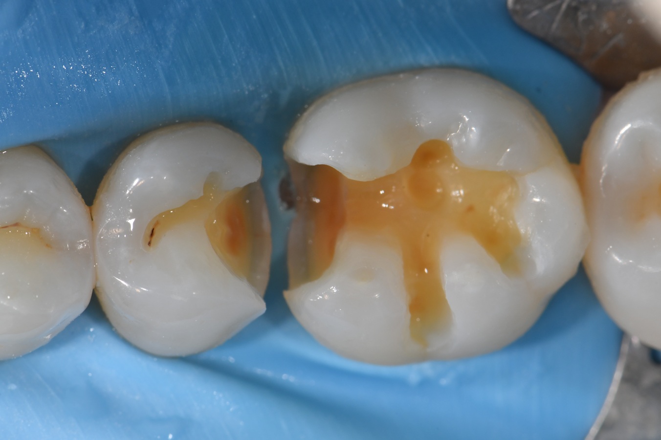Band in band matrix technique for back to back Class II restorations
