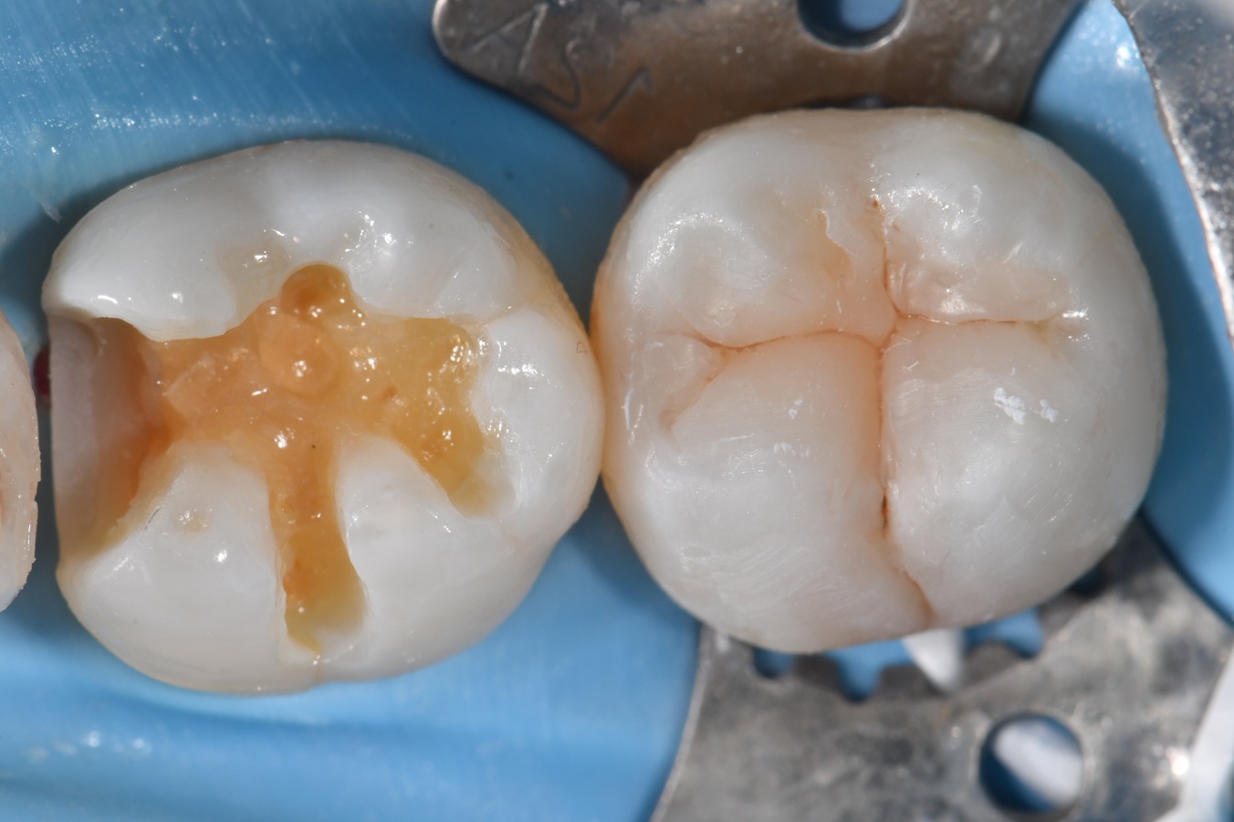 Band in band matrix technique for back to back Class II restorations