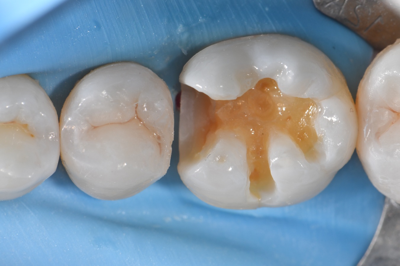 Band in band matrix technique for back to back Class II restorations