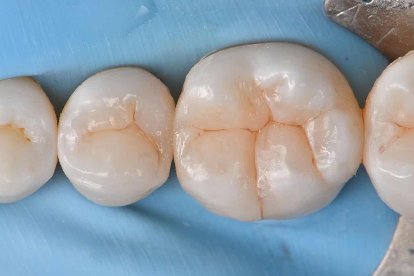 Band in band matrix technique for back to back Class II restorations